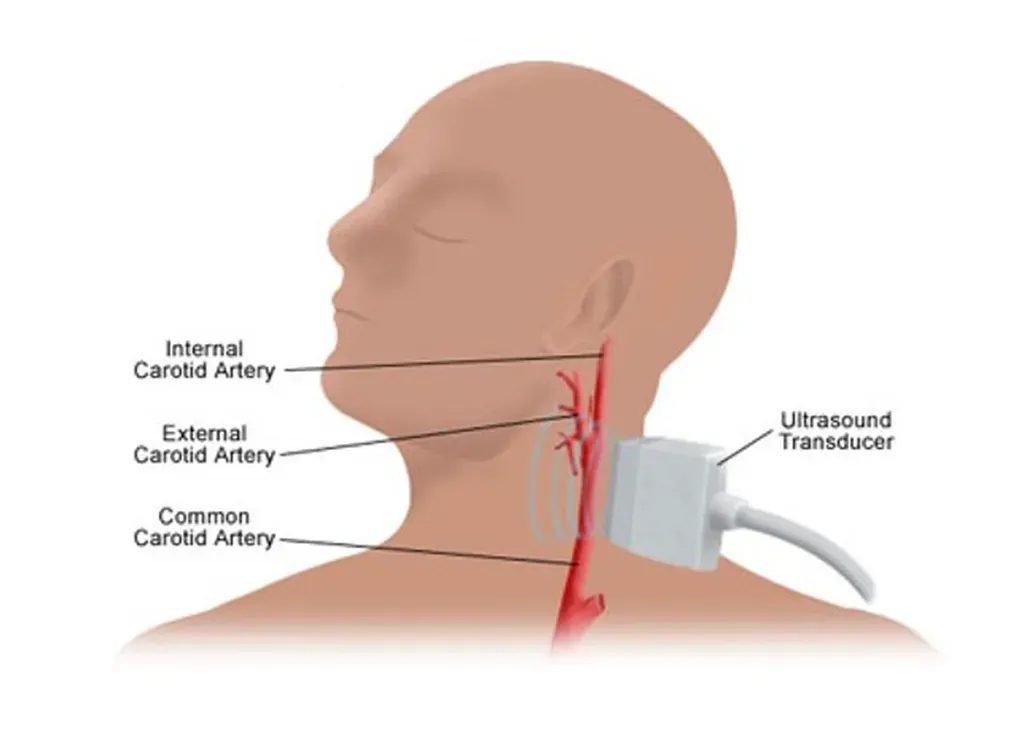Carotid Ultrasound | Cardiac Center of Texas