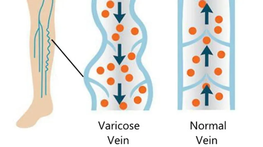 Varicose Veins | Cardiac Center of Texas